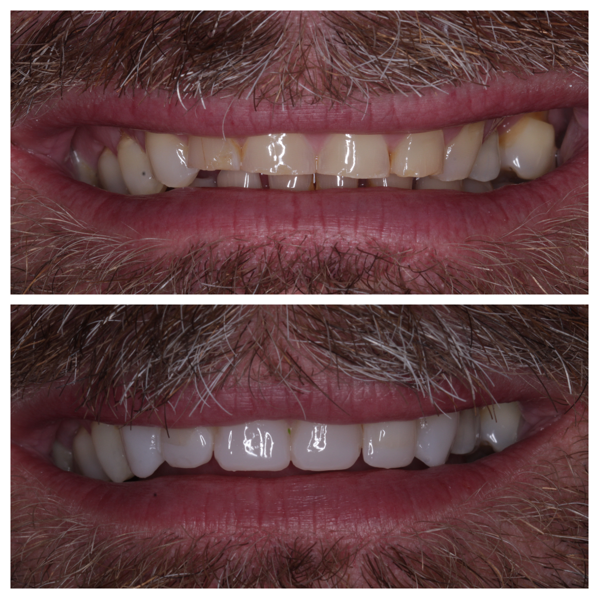 Composite Bonding - Rayner Dental Practice, Bradford, West Yorkshire